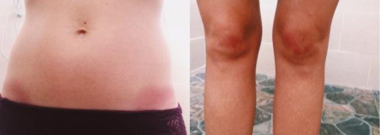 Common Surfing Injuries: Prevention and Recovery